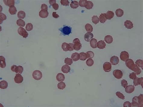 Bone Marrow Aspirate Smear The Haemodilute Aspirate Specimen