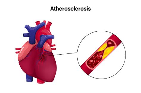 Ilustración De Aterosclerosis Con Concepto De Vector Cardíaco