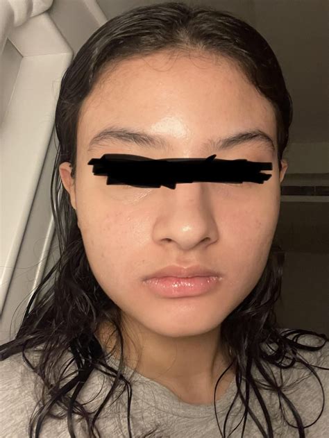 8 Months Tretinoin Results Before And After R Tretinoin