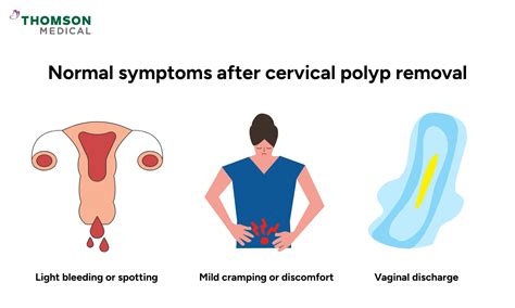 What To Expect After Cervical Polyp Removal And Recovery Tips Thomson