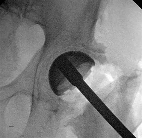 Anterior Approach Ideal For Replacing Auto Fused Hip