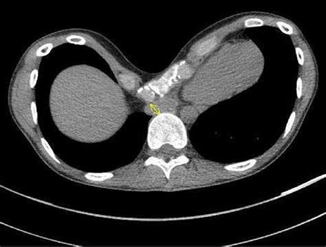 Computerized Tomographic Scan Of A Patient With Severe Pectus Excavatum Download Scientific