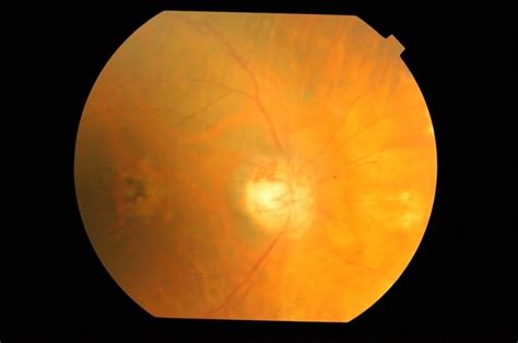 Disc Collaterals Retina Image Bank