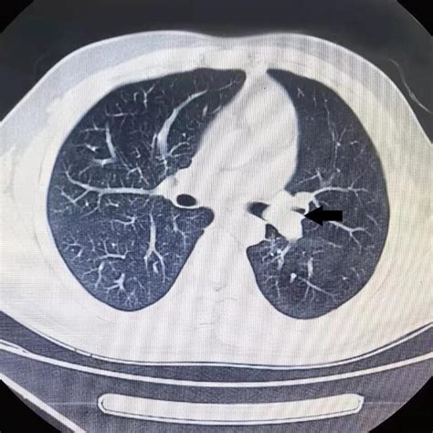Chest Ct Revealed That The Nodular Shaped Lesion With Abundant Blood
