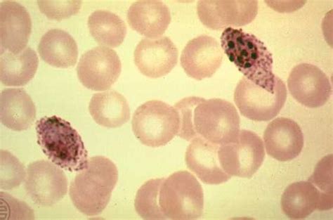 Plasmodium Ovale Wright 100x Muestra De Sangre Provoca Malaria