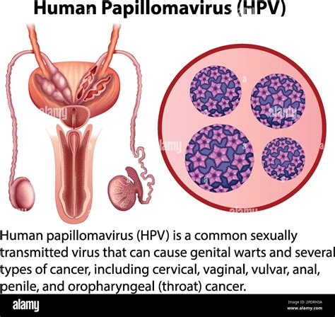 Genital Human Papillomavirus Hpv
