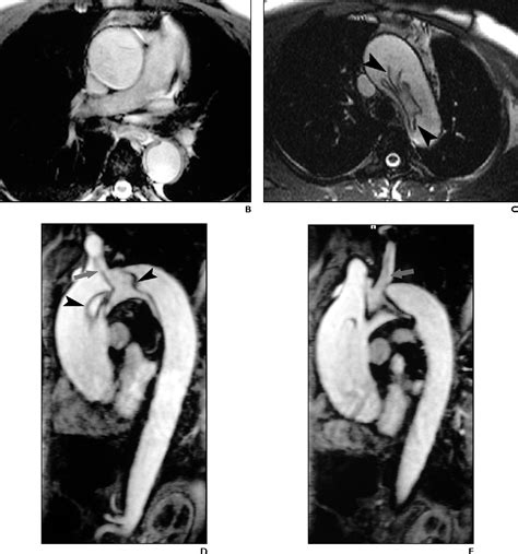 Figure 1 From Acute Aortic Dissection With Intimal Intussusception Mri Appearances Semantic