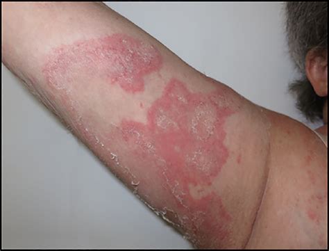 Oval Lesions On Face