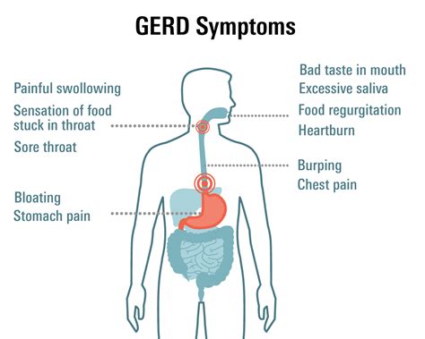 Managing Acid Reflux Omeprazole Vs Pantoprazole