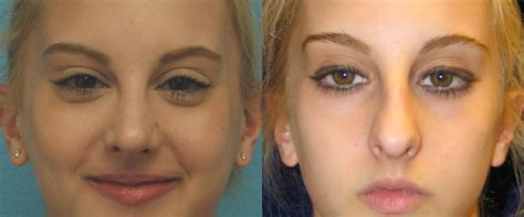 Cheekbone Augmentation Everything You Need To Know About Cheek Implant