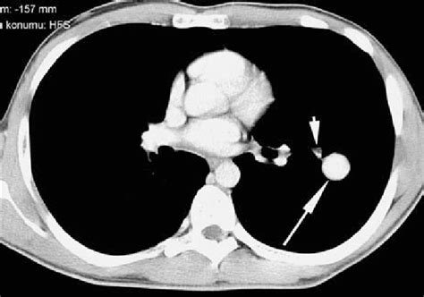 Conventional Ct Scan After Injection Of Contrast Material Reveals A
