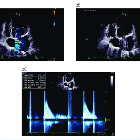 Transthoracic Echocardiography In An Apical Four Chamber View Showing