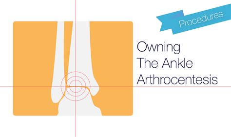 Owning The Ankle Arthrocentesis — Nuem Blog