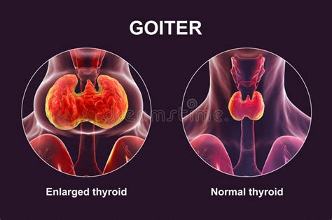 Enlarged Thyroid Gland 3d Illustration Stock Illustration