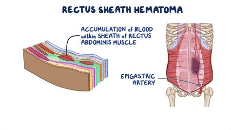 Rectus Sheath Hematoma Clinical Sciences Osmosis Video Library