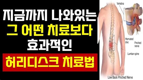 지금까지 나와있는 허리디스크 치료 중에 가장 효과적인 방법 Youtube