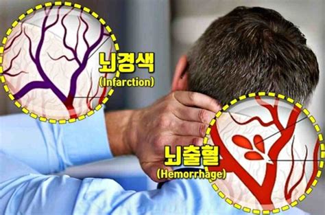 이 증상 있으면 뇌졸중 꼭 의심하세요
