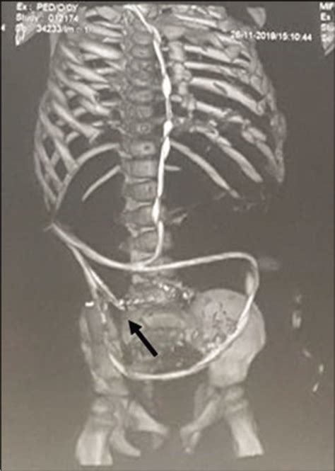 Hydrocephalus Shunt Placement