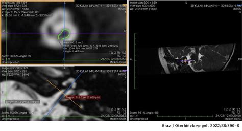 Does Size Of The Cochlear Nerve Affect Postoperative Auditory Performance In Pediatric Cochlear