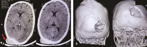 Metastases From Follicular Carcinoma Of Thyroid Head Ct Showing