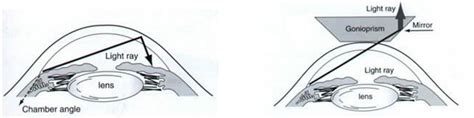Gonioscopy Cure Glaucoma Foundation