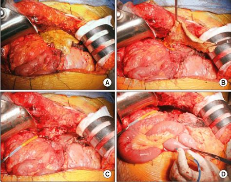 Gross Photographs Of The Surgical Procedure For Necrosectomy Necrotic Download Scientific