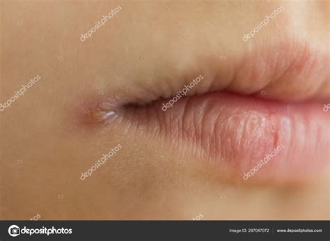 Angular Stomatitis Vs Cold Sore