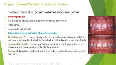 Gingivitis And Periodontal Disease Last Adjusmentspptx