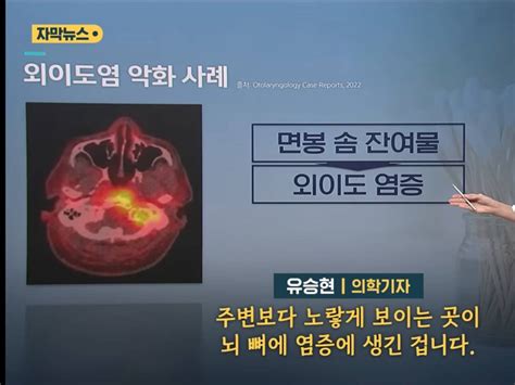 [sbs뉴스] 귓밥 못 참고 팠는데…” 상상도 못할 곳에 퍼졌다 인스티즈 Instiz 인티포털 카테고리