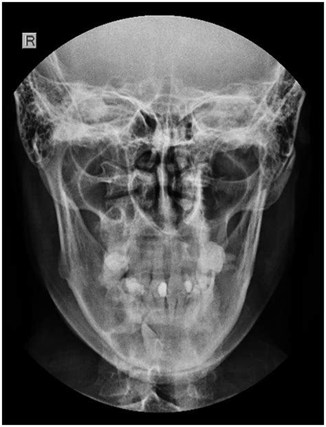 Botryoid Odontogenic Cyst