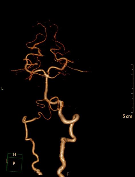 Radiopaedia Case Hypoplastic Vertebral Artery With Pica Termination Id
