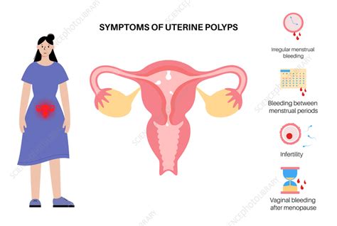 Uterine Polyps Illustration Stock Image F0365592 Science Photo