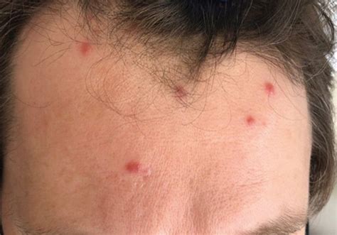 Clinical Photograph Showing Multiple Nodules On The Patients Forehead Download Scientific