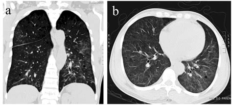 Diffuse Infiltrative Lymphocytosis Syndrome Quotes Trending