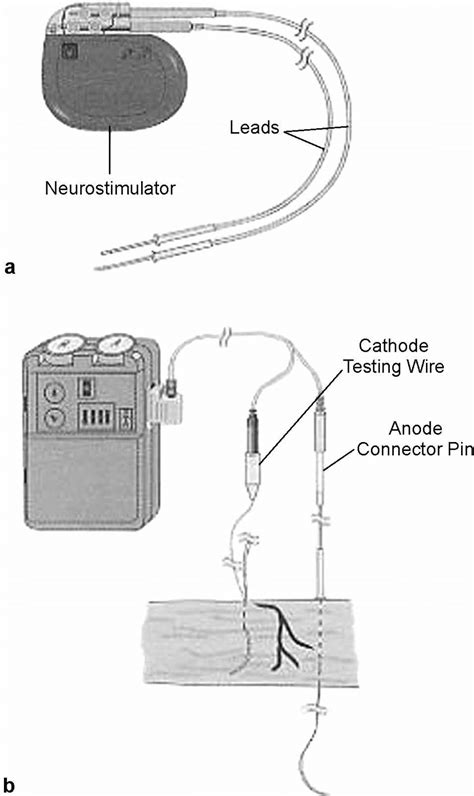 A Implantable Pulse Generator B Leads And Test Stimulator For Download Scientific Diagram