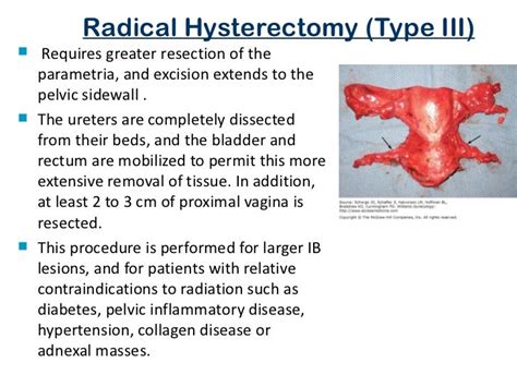 Surgical Management Of Carcinoma Cervix
