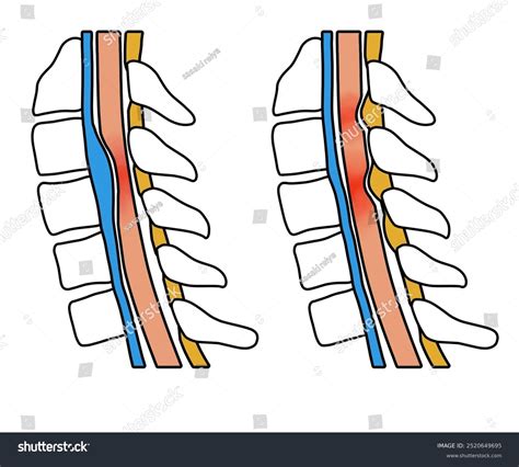 Ossification Posterior Longitudinal Ligament Ossification Ligamentum