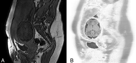 An Axial T1 Weighted Gradient Echo Breath Hold Acquisition Of The Fetal