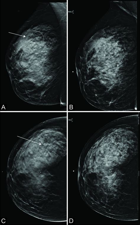 Positive Predictive Value Of Tomosynthesis Guided Biopsies Of Architectural Distortions Seen On