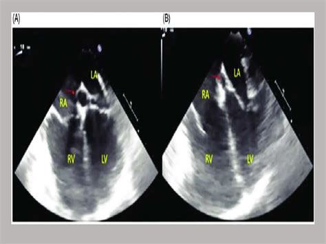 How To Read Echocardiography Of Heart Pptx