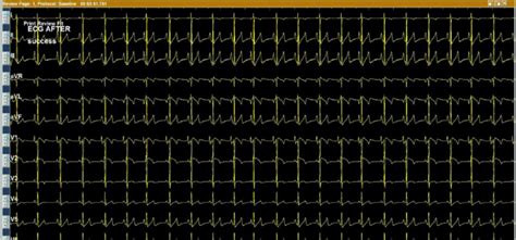 Post Ablation 12 Lead Ecg Showing Sinus Rhythm Download Scientific