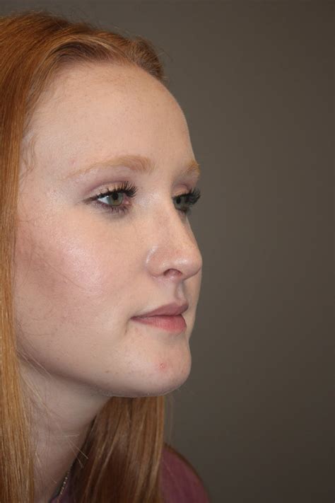 Patient 141113648 Rhinoplasty Before And After Photos Texas Facial