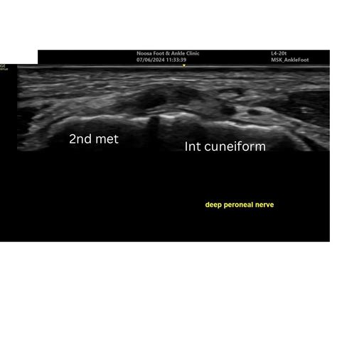 Craig Wanless On Linkedin Interesting Case Today 51 Yo Male Presented With Unilateral Numbness…