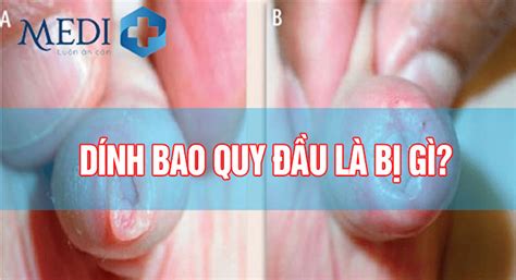 Cắt Bao Quy đầu Xong Kiêng ăn Gì Nên ăn Gì để Nhanh Lành