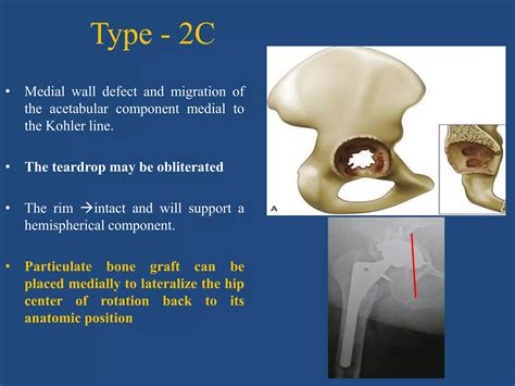 Acetabular Defects Pptx
