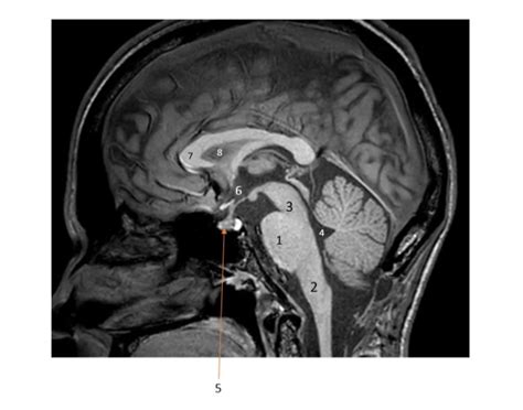 Another Image To Master Sagittal Brain Anatomy Quiz