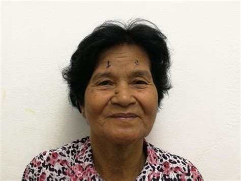 Success Sokhom From Cambodia Raised 225 To Fund Sight Restoring Eye