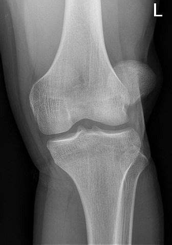 Patellar Malalignment Physiopedia