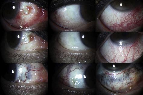 Necrotizing Scleritis After Cosmetic Conjunctivectomy With Mitomycin C