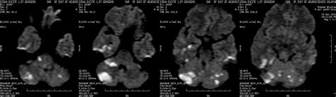 Dr Balaji Anvekar Frcr Vertebral Hypoplastic Vs Thrombosed On Mr Angio